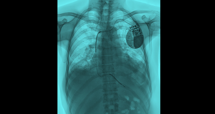 FDA approves new device for treating moderate to severe chronic heart f