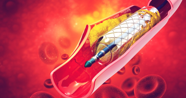 'Smart stent' developed to spot narrowing of arteries