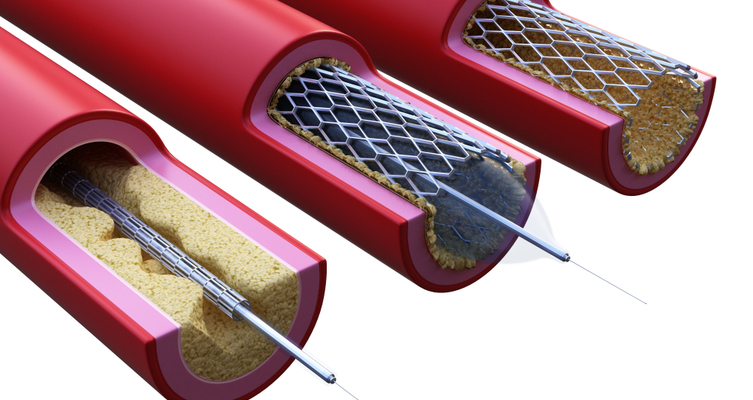 Indian-made stents just as good as the best, according to new study