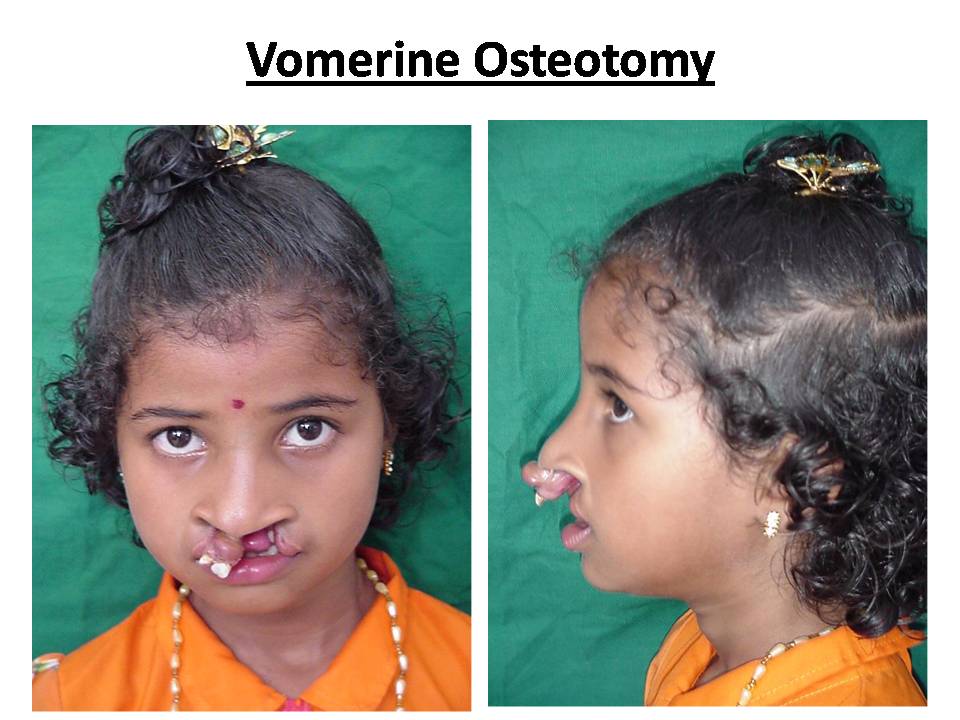 Vomerine Bone – Inga Health Foundation