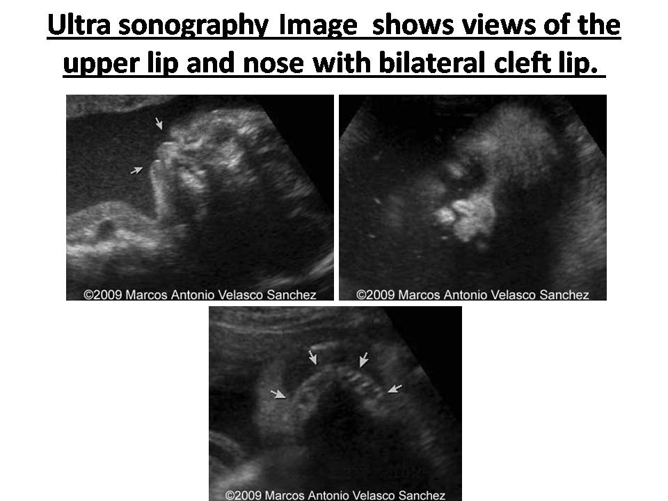 ABOUT CLEFT – Inga Health Foundation